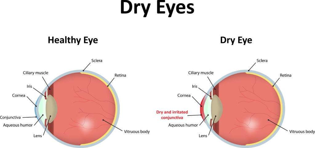 Dry Eyes: Advice From A NH Eye Doctor | Nutfield Eye Associates